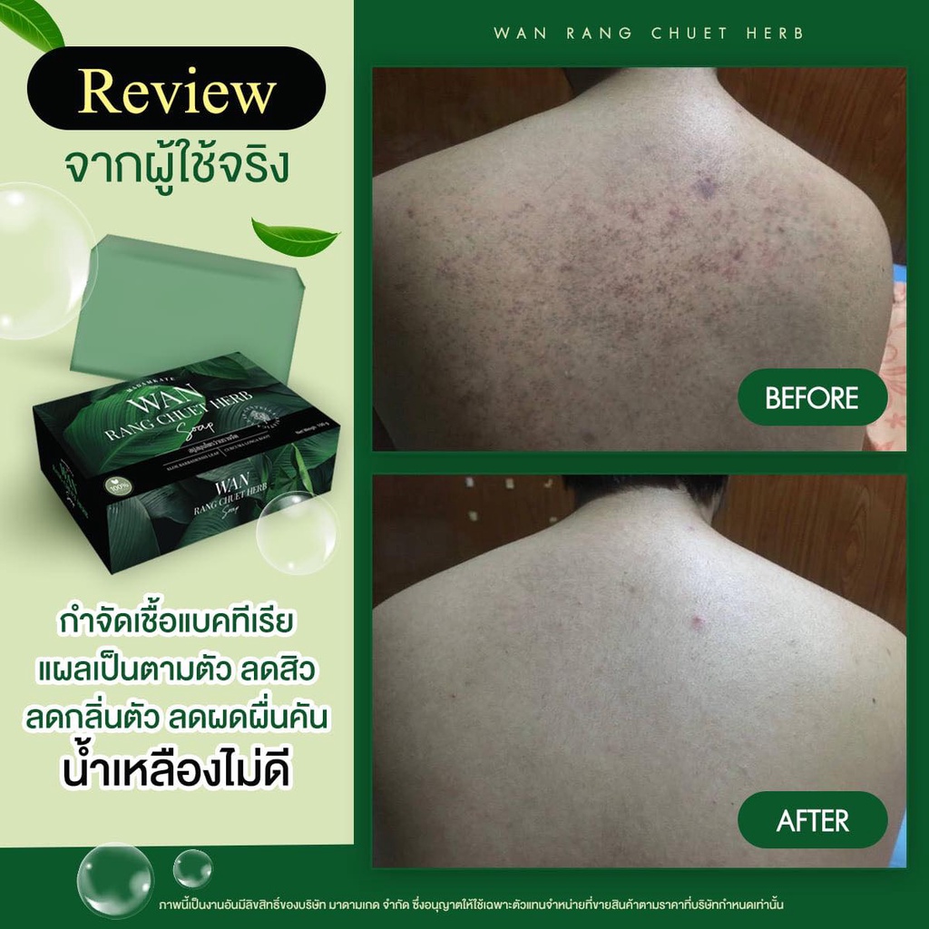 สบู่ว่านรางจืด บชรรเทาอาการคันตามผิวหนัง เชื้อรา กลากเกลื้อน คอดำ ขา ...
