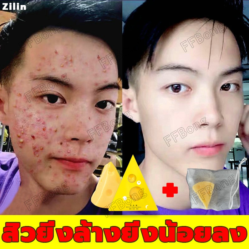 ZiLin ชุ่มชื้น ทำความสะอาด ระงับไร ลบสิว บอกลาผิวหยาบกร้าน สบู่ขาว สบู่ ...