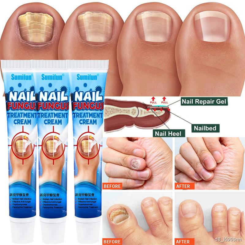 20g Nail Fungus Removal Cream Ointment Onychomycosis Fungal Nail Anti ...