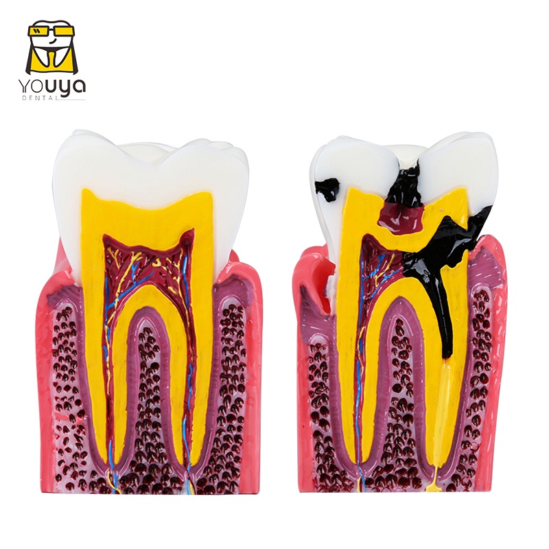 Tooth Model 6 Times Caries Comparison Model Molar Pathology Anatomy ...