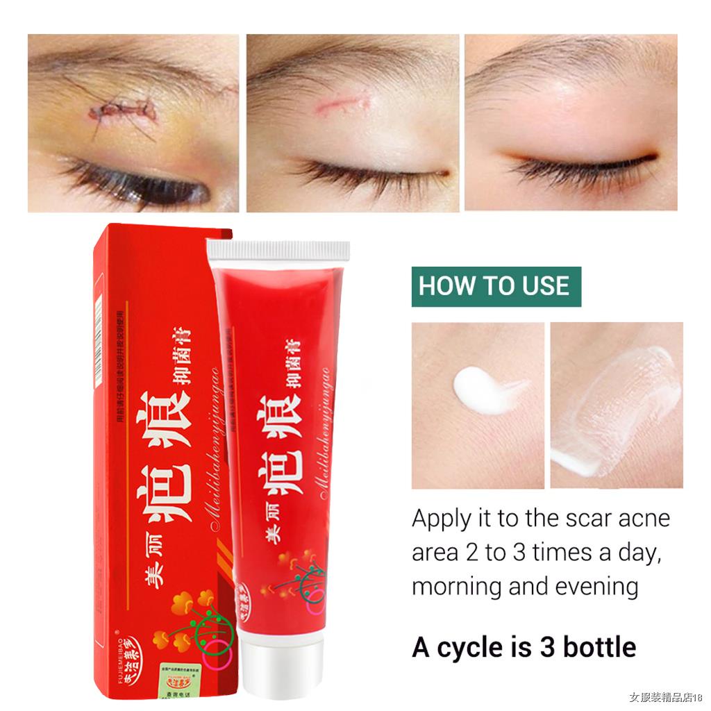Acne Scar Removal Cream Pimples Stretch Marks Face Gel Remove Acne ...