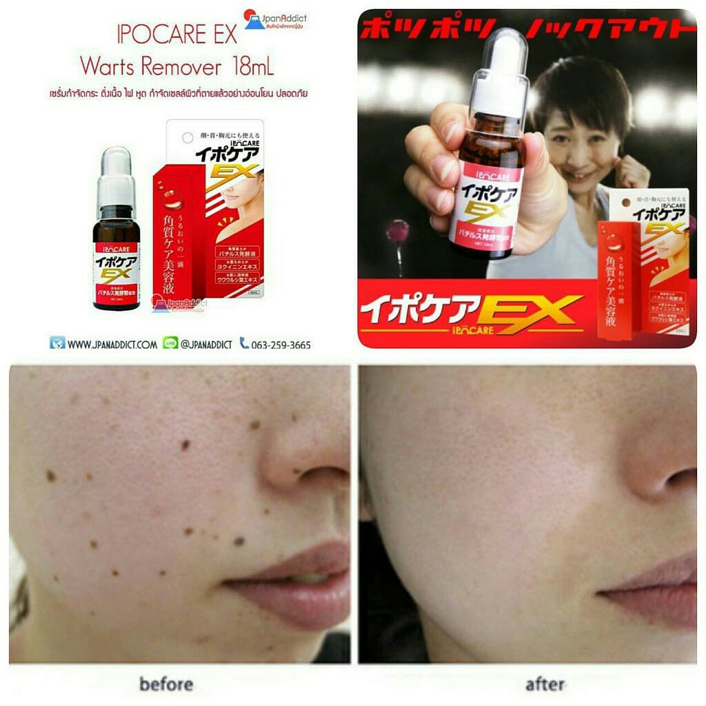 Ipocare Ex 18ml เซรั่มกำจัดกระ ติ่งเนื้อ ไฝ หูด กำจัดเซลล์ผิวที่ตายแล้วได้อย่างอ่อนโยน | Shopee ...