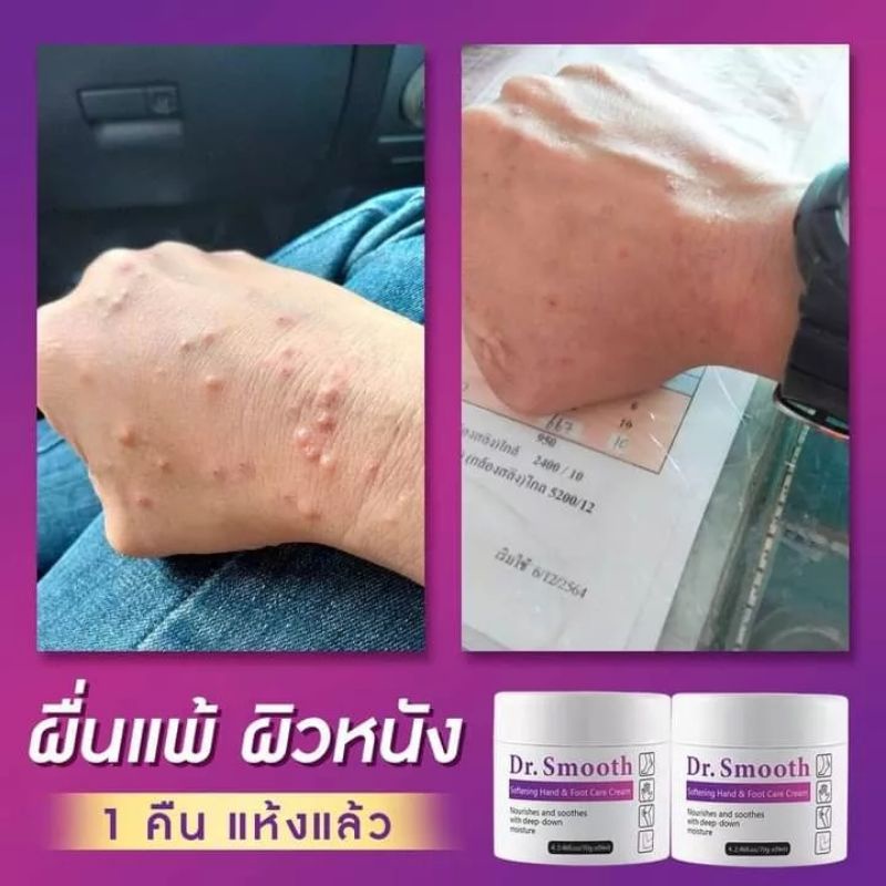 🔥แนะนำๆ🔥Dr.smooth ครีมทา ดูแลปัญหา ผด ผื่น ตุ่มแดง ตุ่มใส อาการคัน เรื้อรัง ยิ่งเกายิ่งลาม ลดรอย ...
