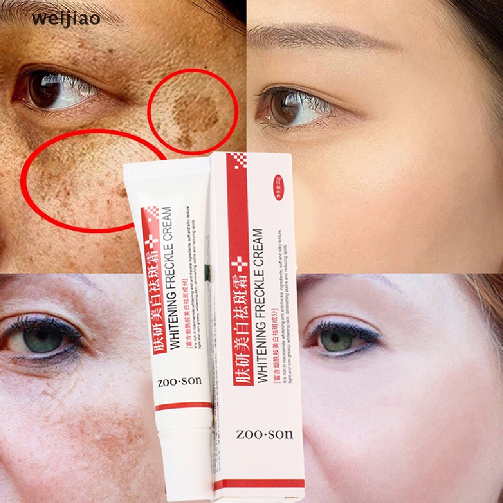 wei Freckle Cream Remove Skin Melasma Acne Spot Pigment Melanin Dark Spots Whitening ie | Shopee ...