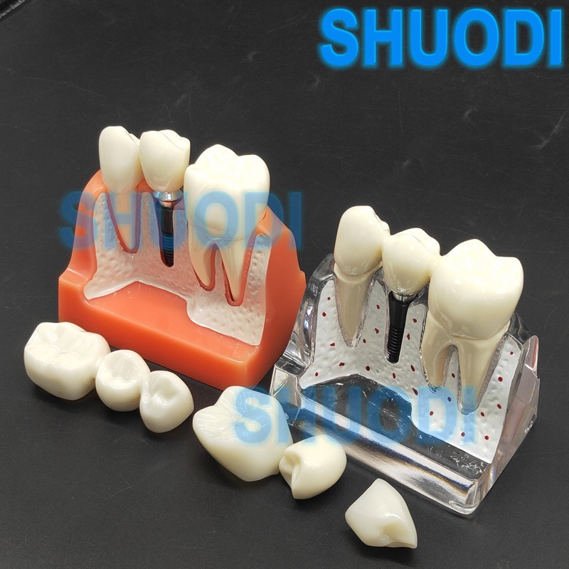 4 Times Dental Teeth Teaching study Model Dental Implant Disease ...