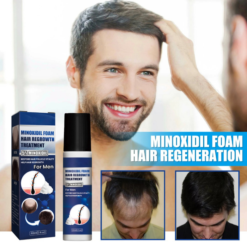 Minoxidil ทรีทเม้นท์บํารุงเส้นผม ความแข็งแรงพิเศษ สําหรับผู้ชาย | Shopee Thailand