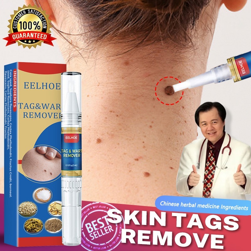 Original Warts Remover Watson Warts Removal Mole และ Warts Remover Skin ...