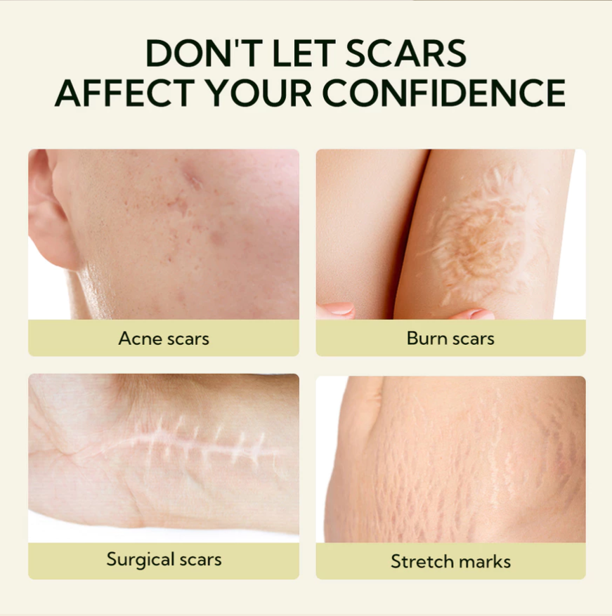 LANBENA Tcm Scar And Acne Mark Removal Gel Ointment+Scar Removal ...