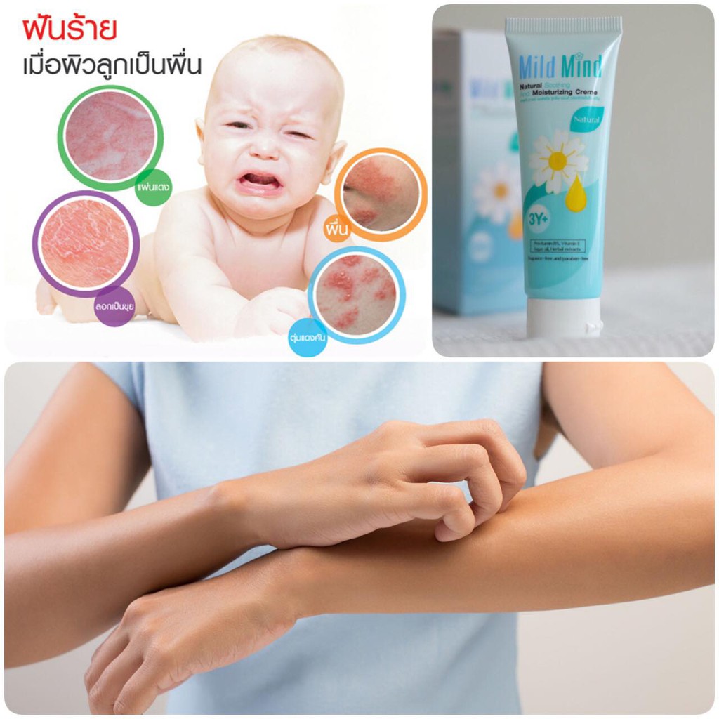 ผื่นแดง คัน เห่อ ผื่นผ้าอ้อม MILD MIND Natural Soothing Cream 15 G ...
