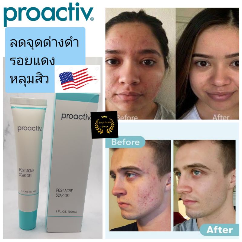 Proactiv post acne scar gel โปรแอคทีฟ ครีมลดหลุมสิว จุดด่างดำ รอยแดงจาก ...