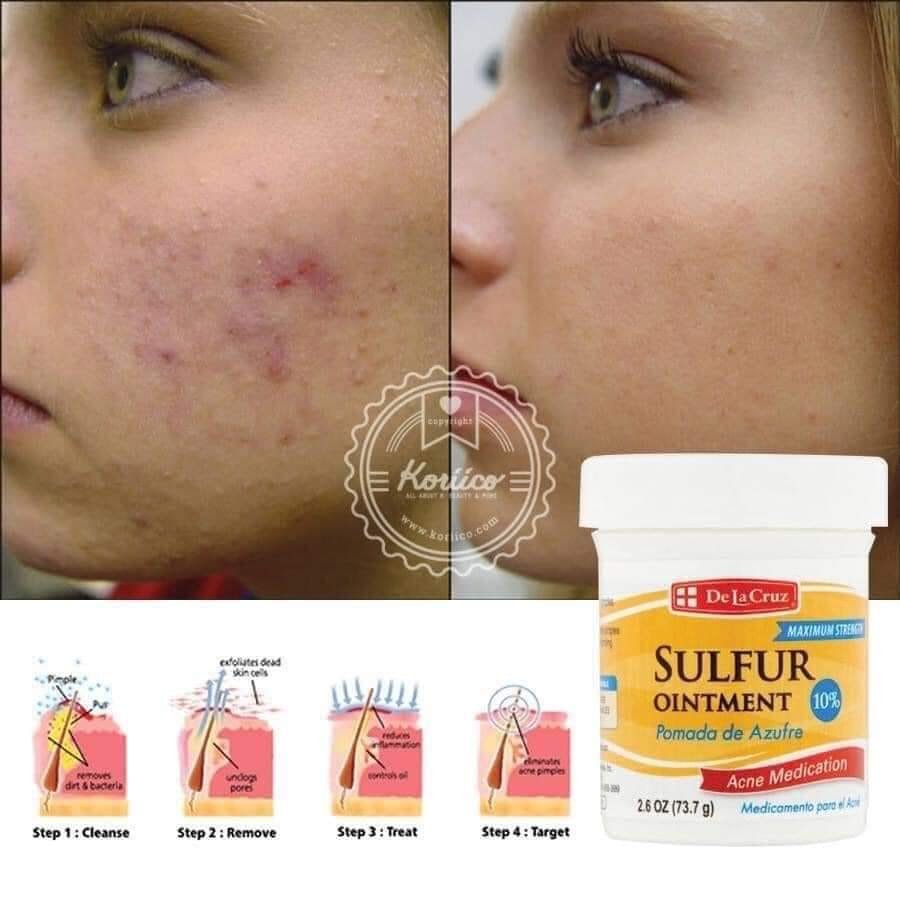 DE LA CRUZ: ขี้ผึ้งรักษาสิว SULFUR OINTMENT (10% SULFUR) ขนาด 6 g ...