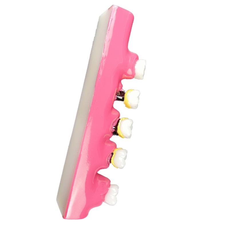 โมเดลฟัน รุ่น Caries Evolution 5 Stage Demo สําหรับทันตกรรม | Shopee ...