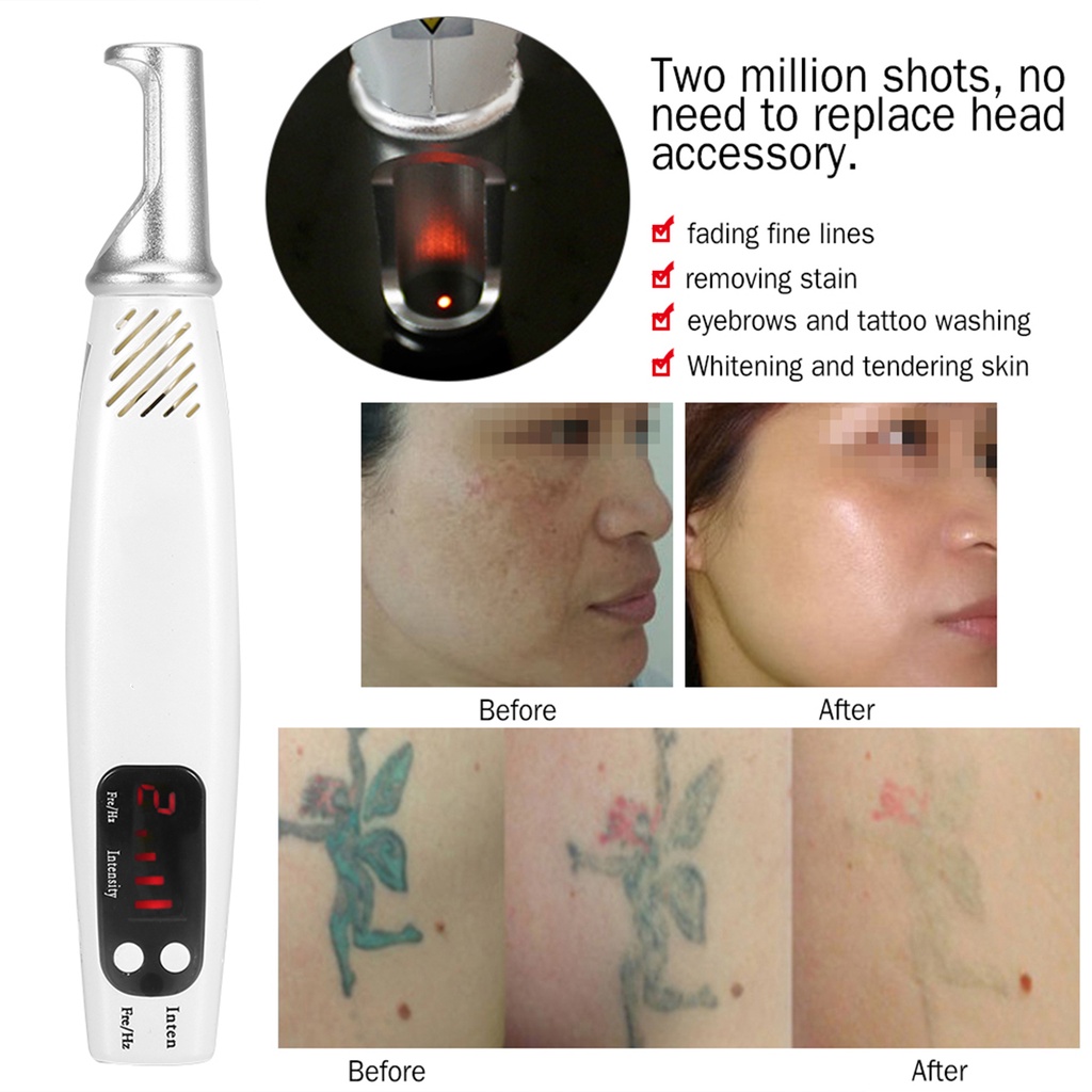 Mother & Baby Handheald Red Light Picosecond ปากกาเลเซอร์ แผลเป็น ลบรอย ...