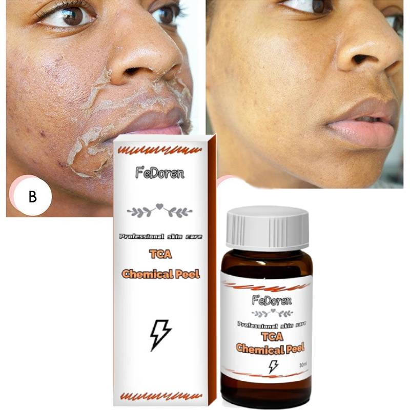 Tca PEELING SOLUTION 30% 50% 70% 30ML / ปลอดภัยสําหรับผิว/ ลบสิวฝ้า หลุมสิว | Shopee Thailand