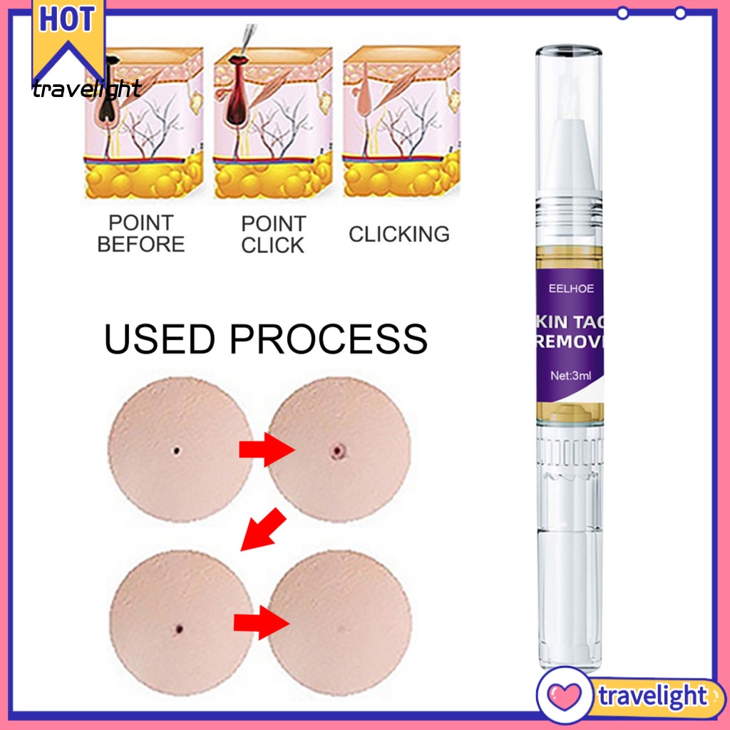 Travelight| 3 มล. / ขวด กําจัดหูด ของเหลว จากธรรมชาติ ขนาดกะทัดรัด ...