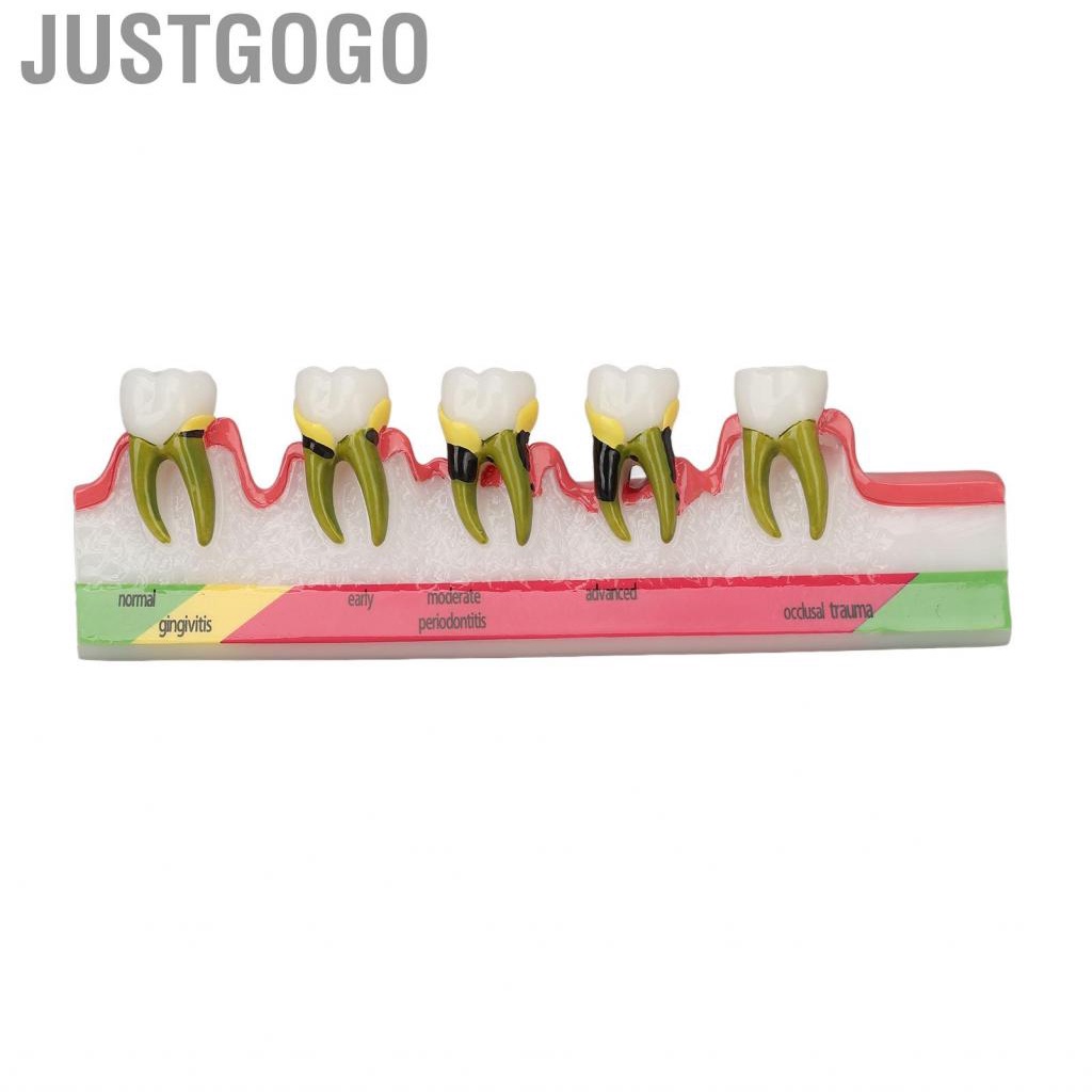 Justgogo Dental Periodontal Disease Model Different Stages ...