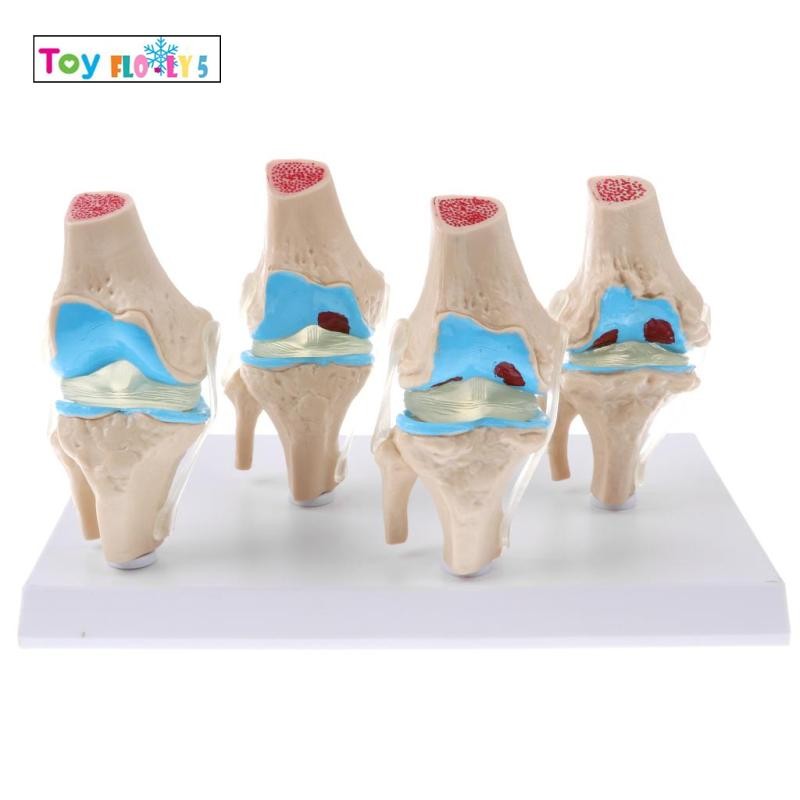 [Flurishroly5] Human Knee Joint Disc Lesion Skeleton Model การสอนพยาธิ ...
