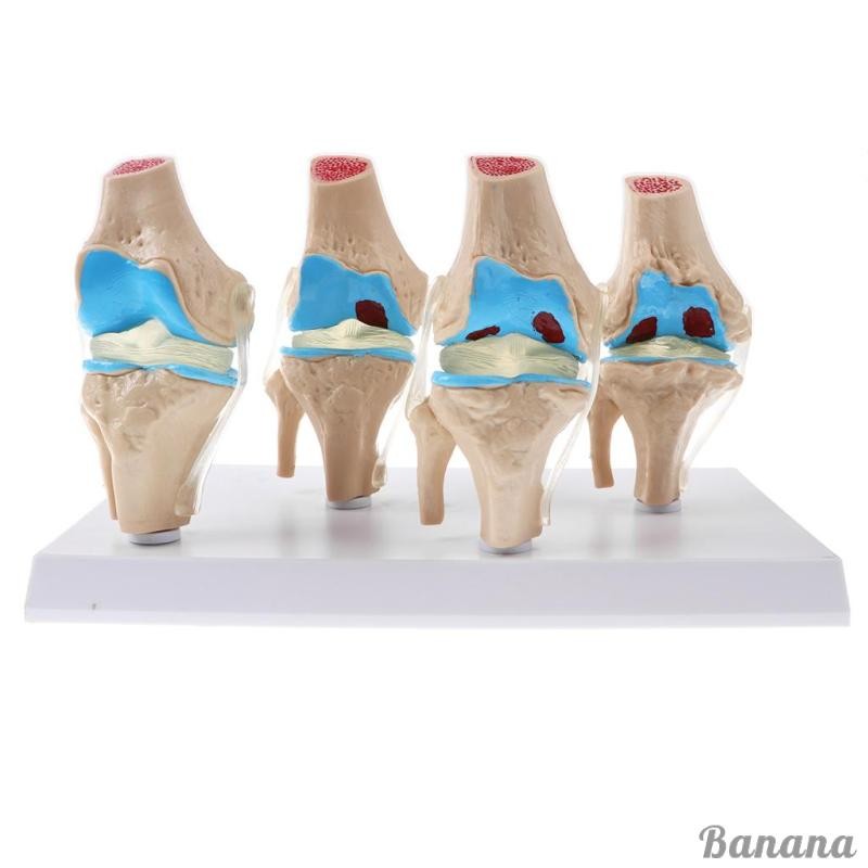 [ในสต็อก] Human Knee Joint Disc Lesion Skeleton Model Pathology ...