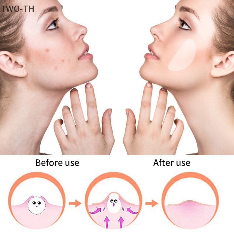 Two-th 5 ชิ้นสิวสิวแพทช์สติกเกอร์สิว Spot Treatment Patch Skin Care ...