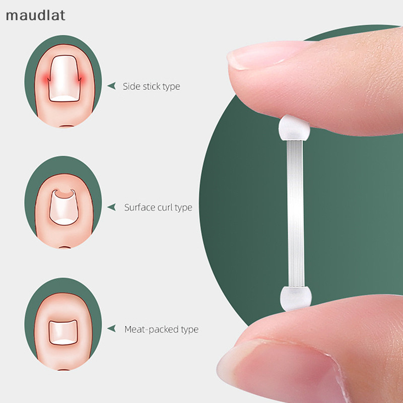 Maud Ingrown Toenail Corrector เครื ่ องมือ Pedicure Recover Embed Toe ...