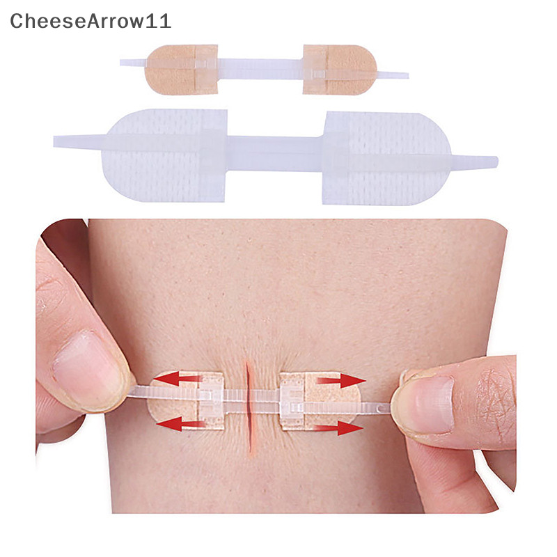Che Zipper Tie Wound Closure Patch Hemostatic Patch Wound Fast Suture ...