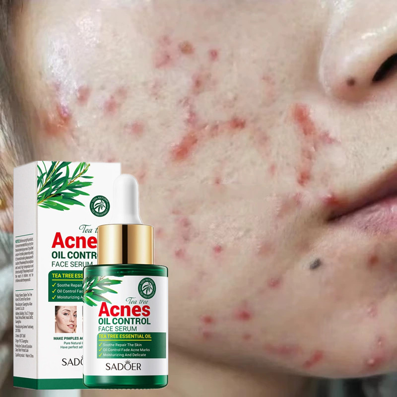 Tea Tree Acne Oil Control Serum Gentle Acne Removal Repair Acne Marks ...