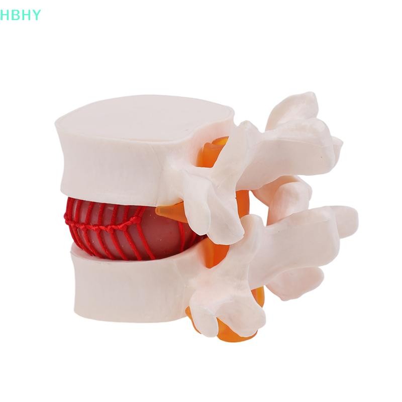 HB Human Anatomy Skeleton Spine Lumbar Disc Herniationการสอนรุ่นสมอง ...