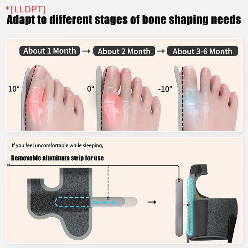 [LLDPT] 2 ชิ้น Toe Orthotics Hallux Valgus Orthotics Orthotics ...
