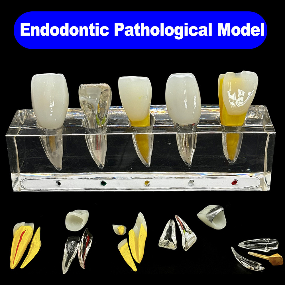 ทันตกรรมเรซิ่นการสอนรุ่น Endodontic Pathology Anterior ด้านหน้าเขาวงกต ...
