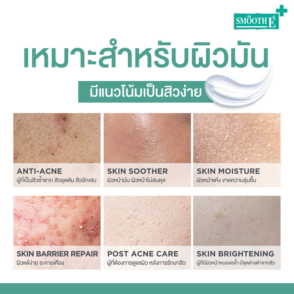 [ซื้อ 1 ฟรี 2] Smooth E Acne Pro Oil Control Serum free Acne & SCA ...