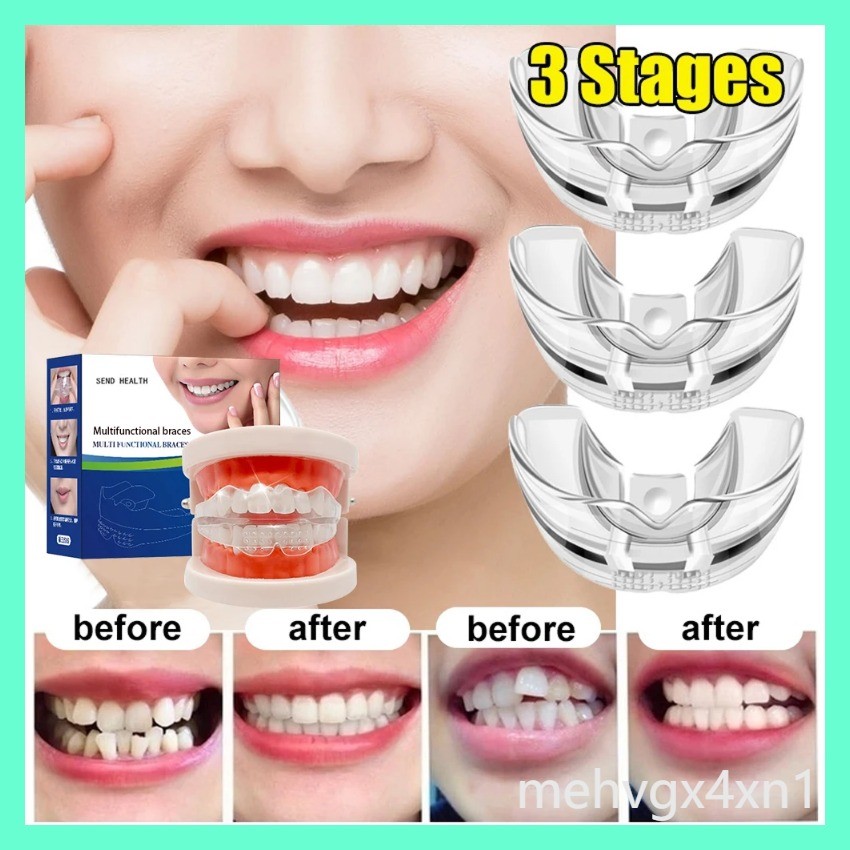 A Three Stages Silicone Tooth For Adults Invisible Orthodontic Set ...