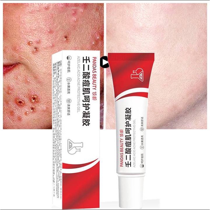 ในสต็อก Azelaic Acne Repairing Gel artifact Azelaic Acid Gel Acne Cream ...
