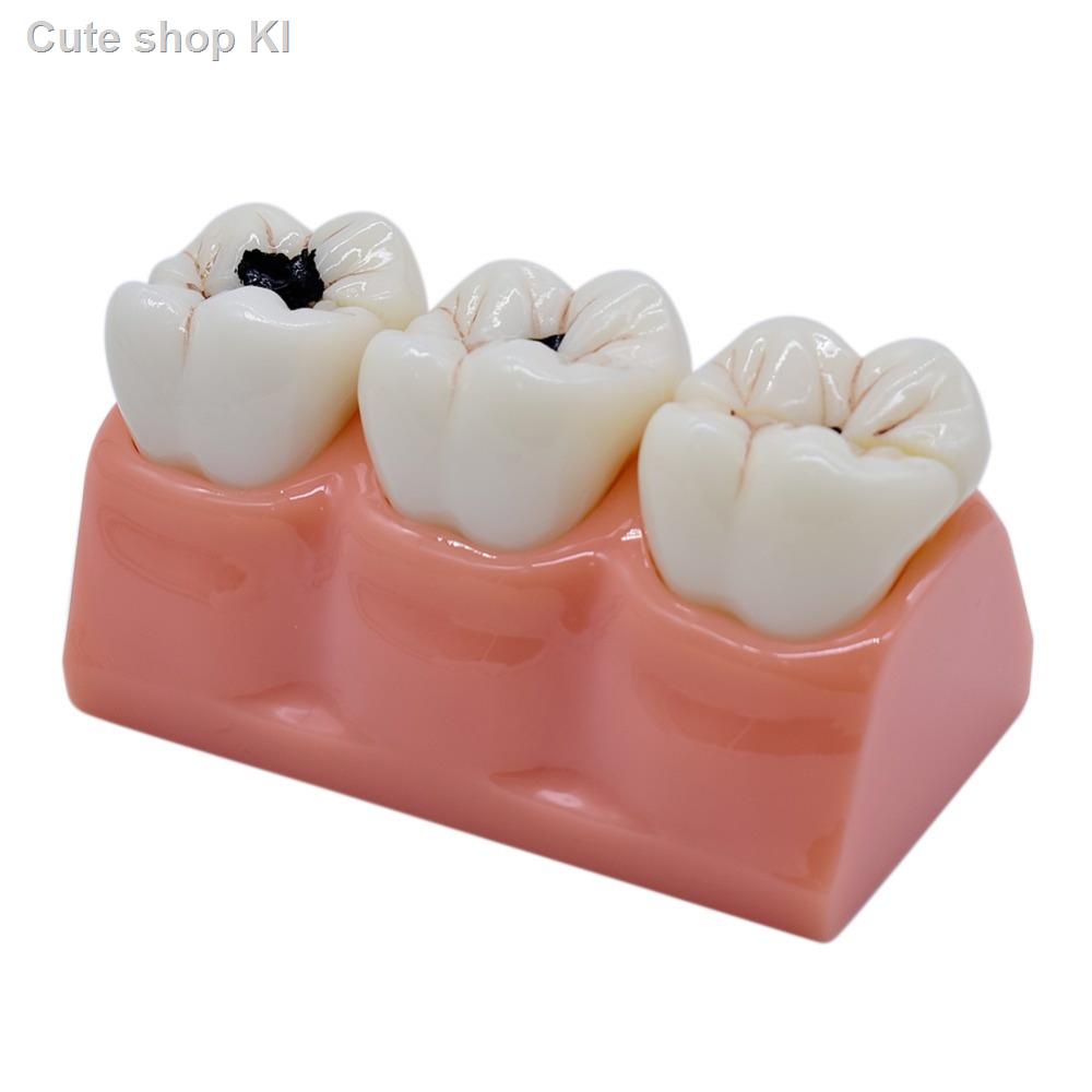 Dental Model Four Times Caries Evolution Model Tooth Decay ...
