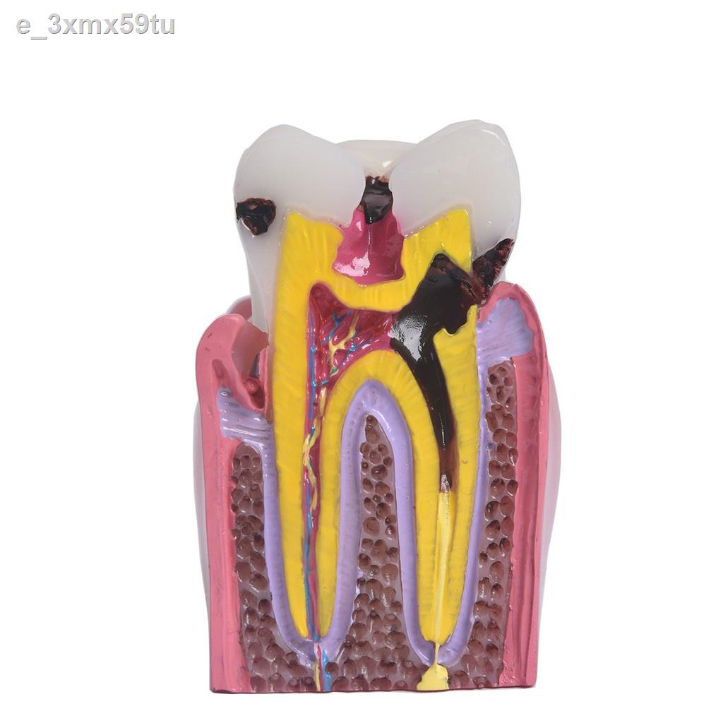 Dental Anatomy Education Teeth Model 6 Times Caries Comparation Study ...