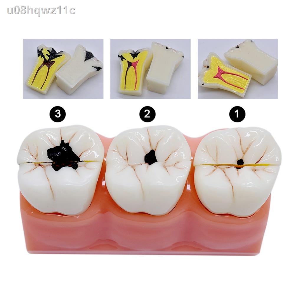 Dental Model Four Times Caries Evolution Model Tooth Decay ...