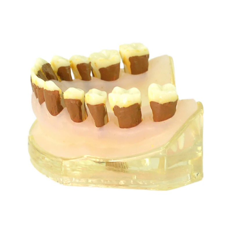 Dental Periodontal Disease Teeth Model Teach Study Model Demonstration ...
