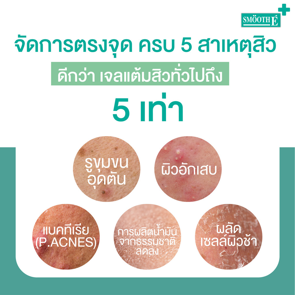 [ใหม่!] Smooth E Acne-5 Rapid Action Plus 10g. เจลแต้มสิว สำหรับผิวบอบ ...