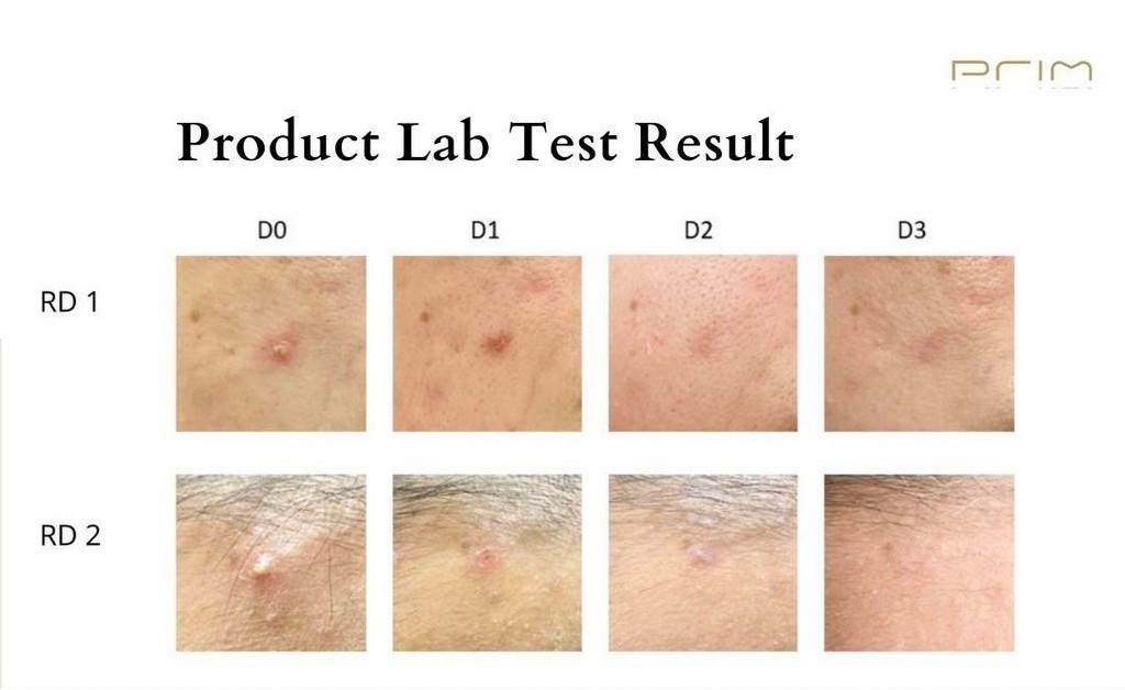 FN PRIM เจลแต้มสิว CBD แอคเน่เจล RESTQUE ACNE GEL 5G. หมายเลขใบอนุญาต ...