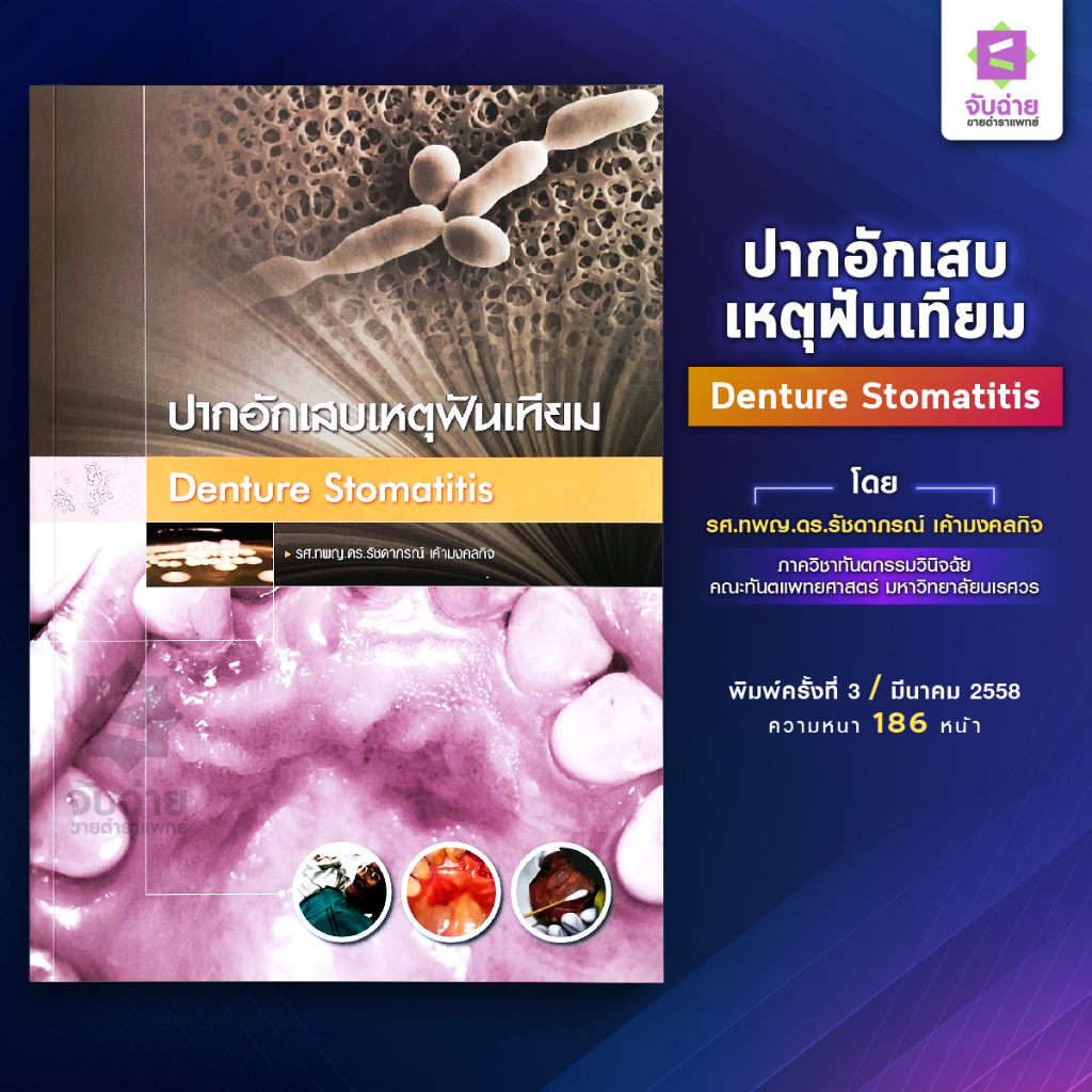 ปากอักเสบเหตุฟันเทียม (Denture stomatitis) | Shopee Thailand