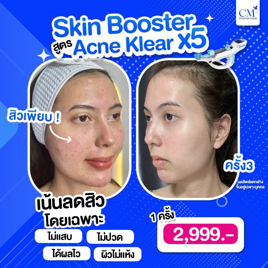 [E-Voucher] Skin Booster สูตร Acne Klear x5 by Charmer Clinic | Shopee Thailand