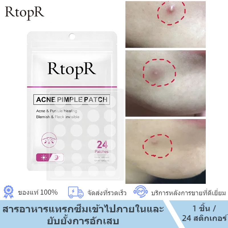 RtopR แผ่นแปะสิว แผ่นดูดสิว ช่วยลดอาการอักเสบของสิว รักษาสิว ชนิดมองไม่ ...