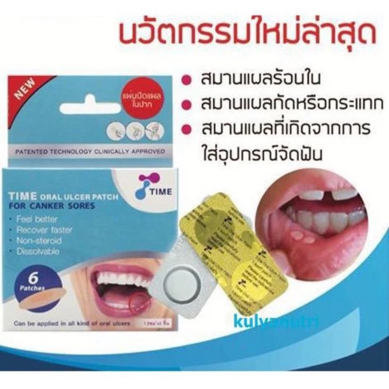 [ถูกสุด]แผ่นปิดแผลในปาก Time Oral Ulcer Patch 6 ชิ้น [1 กล่อง] แผลร้อน ...