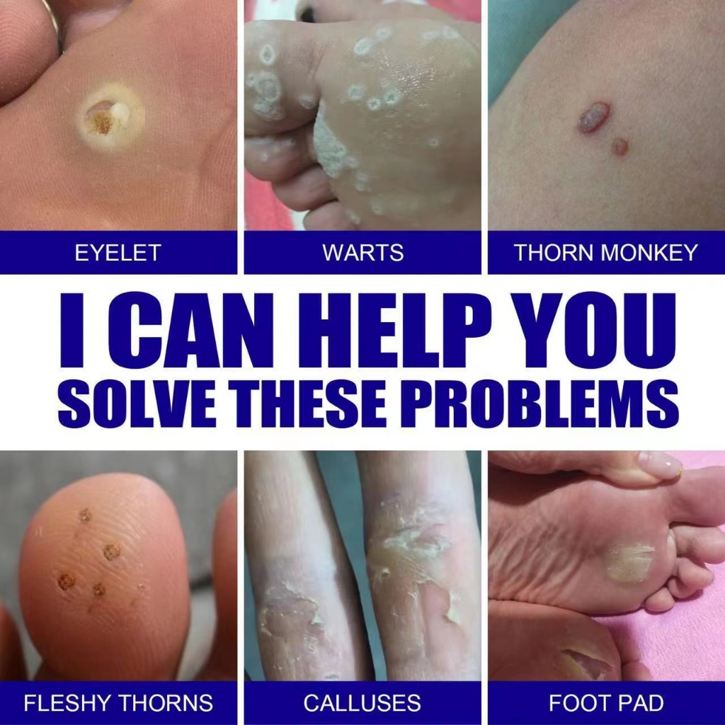 Warts and warts cream, wart cream, filamentous corns cream, warts and ...