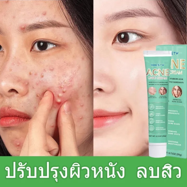 COD จัดส่งภายในระบบ Acne cream Pimple cream Acne serum Acne gel Acne ...
