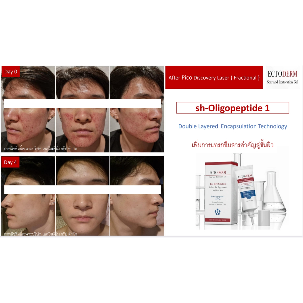 ECTODERM Scar and Restoration Gel +แถม ของแท้ จำหน่ายโดยคลินิก ...
