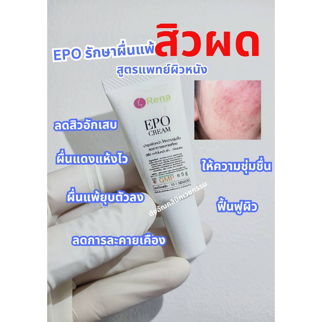 ดังอัณคลินิก EPO Cream รักษาสิวผด รักษาอาการผื่นแพ้สูตรแพทย์ผิวหนัง 5g ...