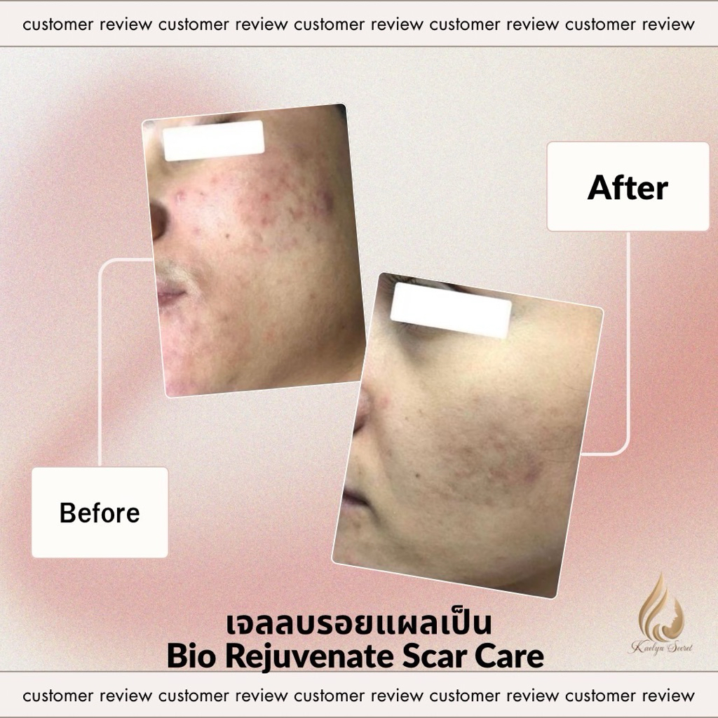 เจลรักษารอยแผลเป็น Bio Rejuvenate Scar Care (ไบโอ รีจูวีเนท สการ์ แคร์ ...