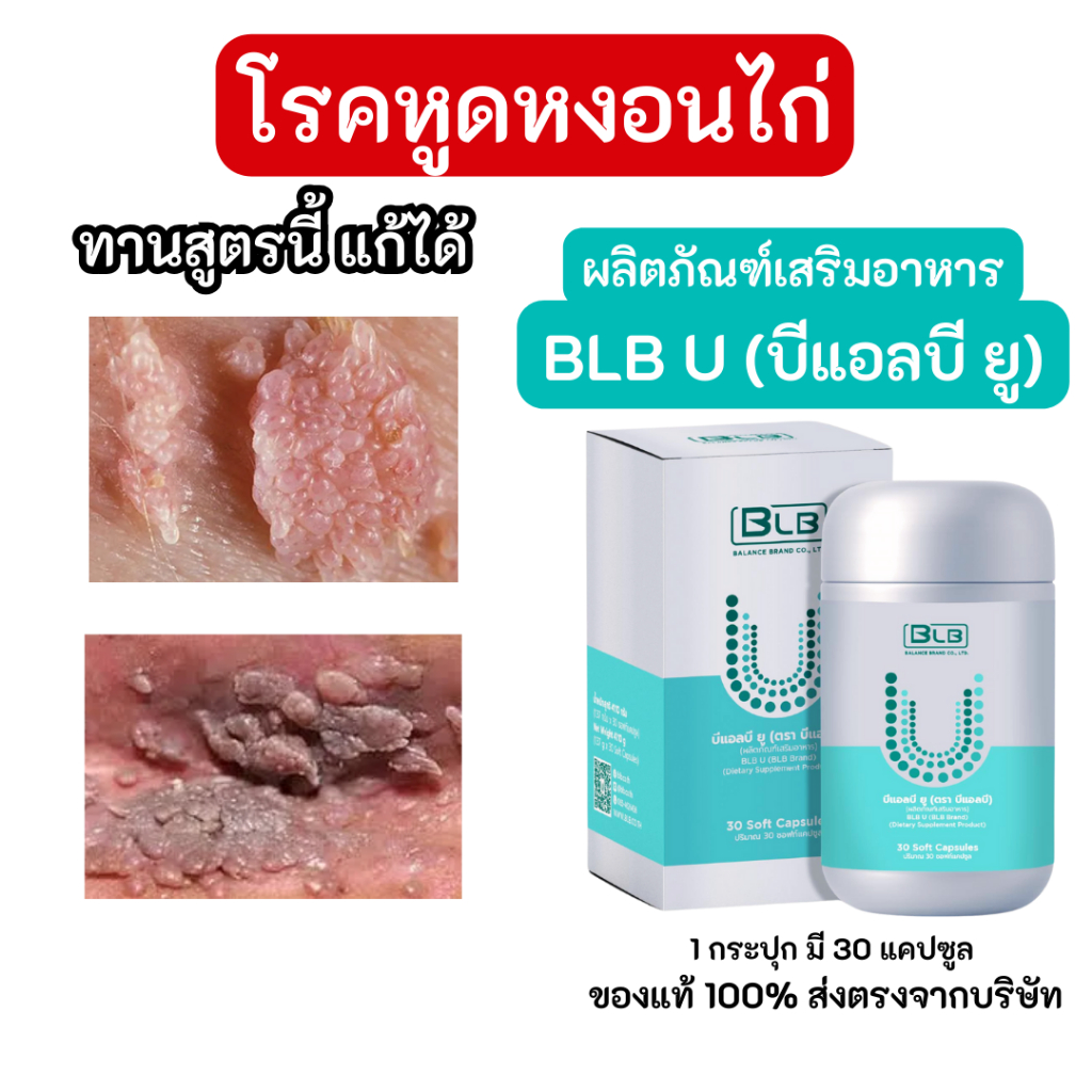 โรคหูดหงอนไก่ สูตรนี้ช่วยได้ Balance BLB U บีแอลบียู ผลิตภัณฑ์เสริมอาหาร ที่สกัดจากสมุนไพร 13 ...