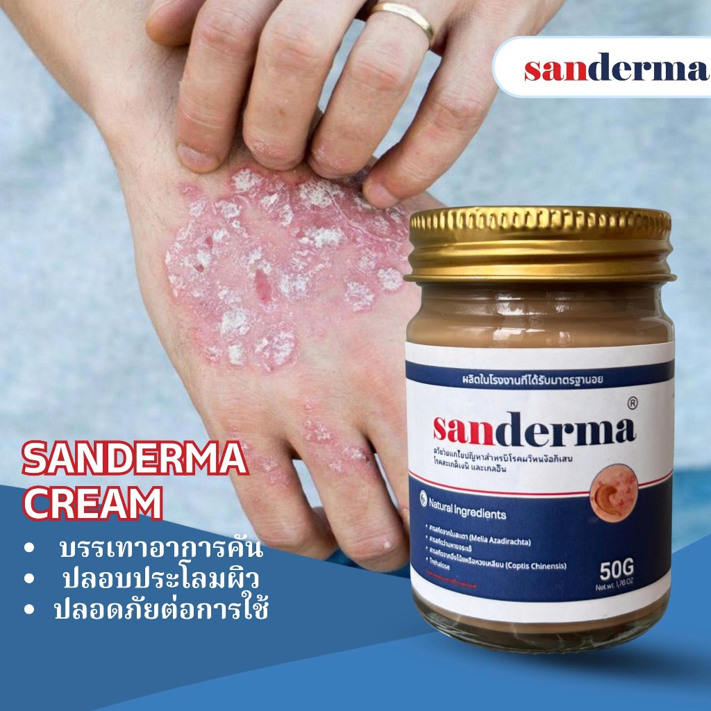 ครีมแก้คันผิวหนัง Sanderma Cream ครีมแก้คันผิวหนัง สำหรับผิวแห้ง ผิวลอก ...