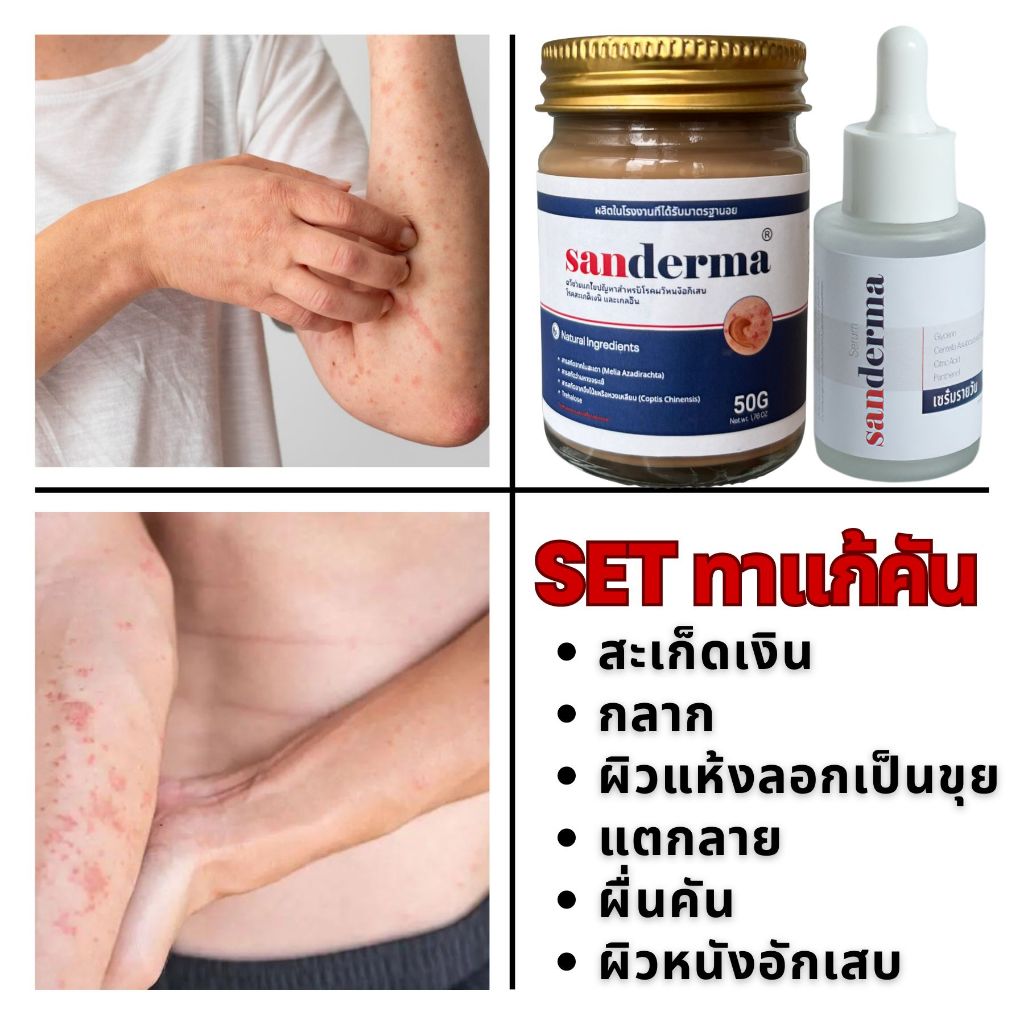 COMBO ทาแก้คัน SANDERMA CREAM และ SERUM SANDERMA | Shopee Thailand